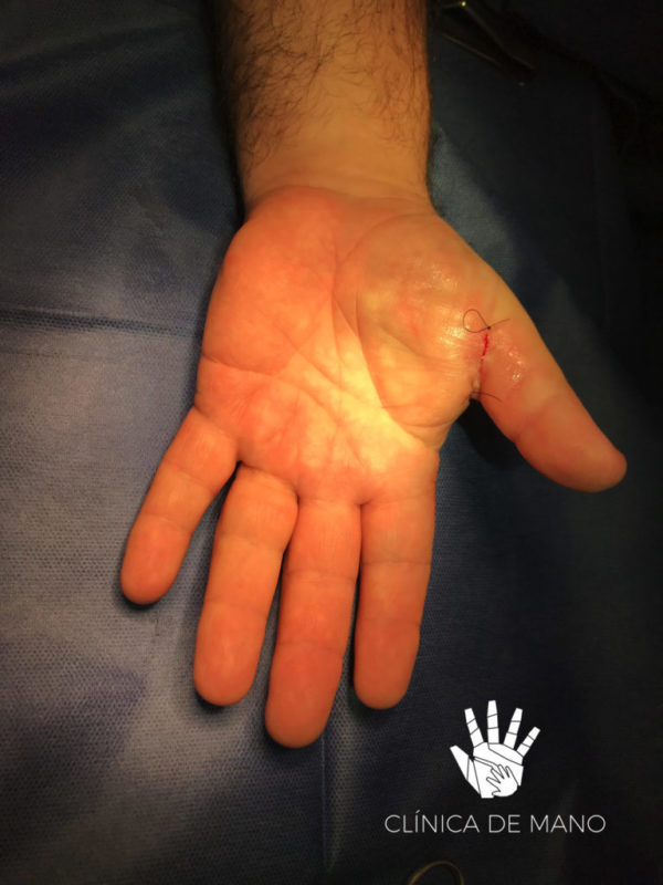 Dedo en Resorte (en Gatillo) - Clínica de Mano