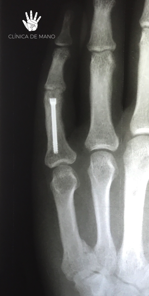 osteosintesis-tornillo-intramedular-fractura-falange-metacarpiano ...
