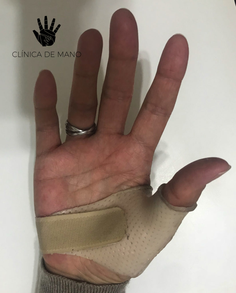 Imágenes de diferentes tratamientos de Rizartrosis - Clínica de Mano
