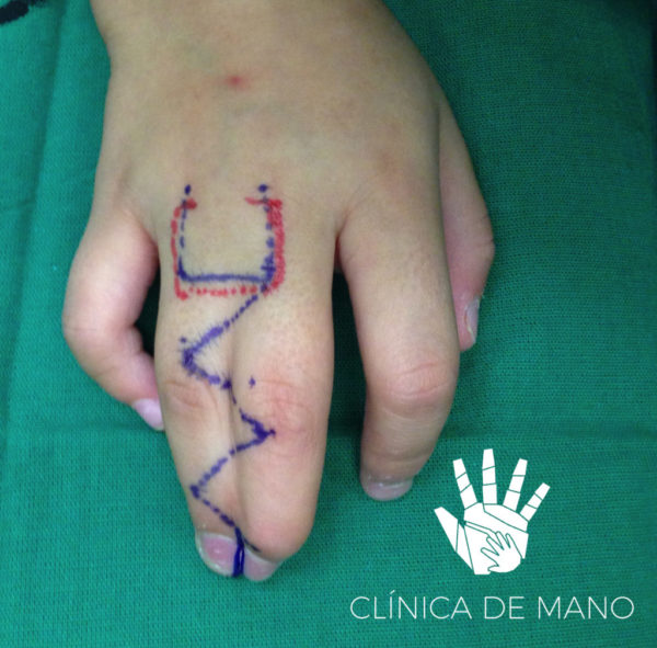Sindactilia de mano - Clínica de Mano