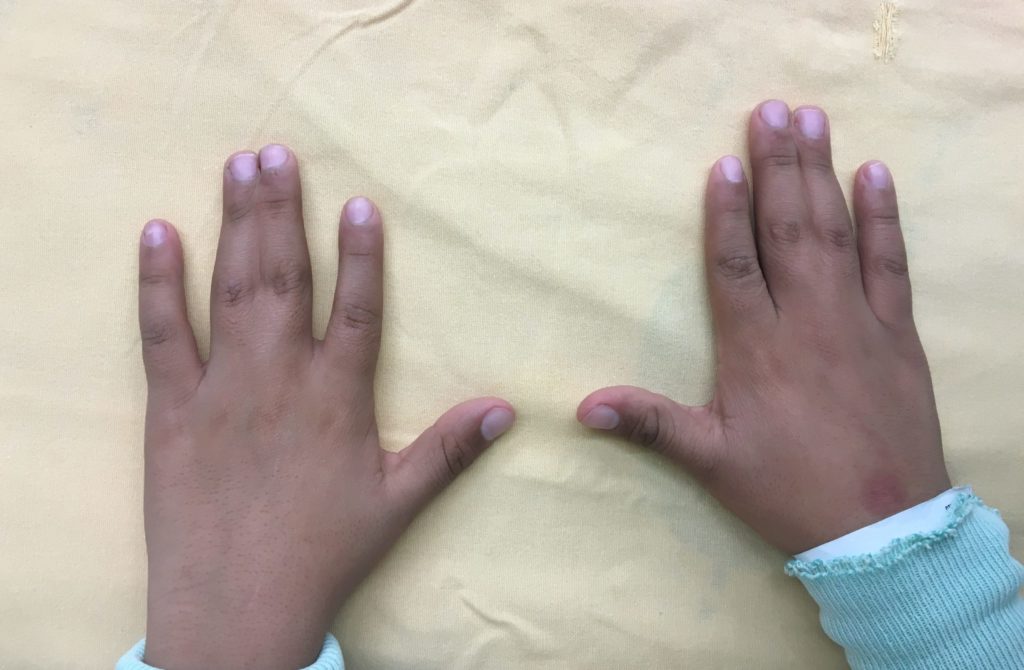 Sindactilia - Clínica de Mano